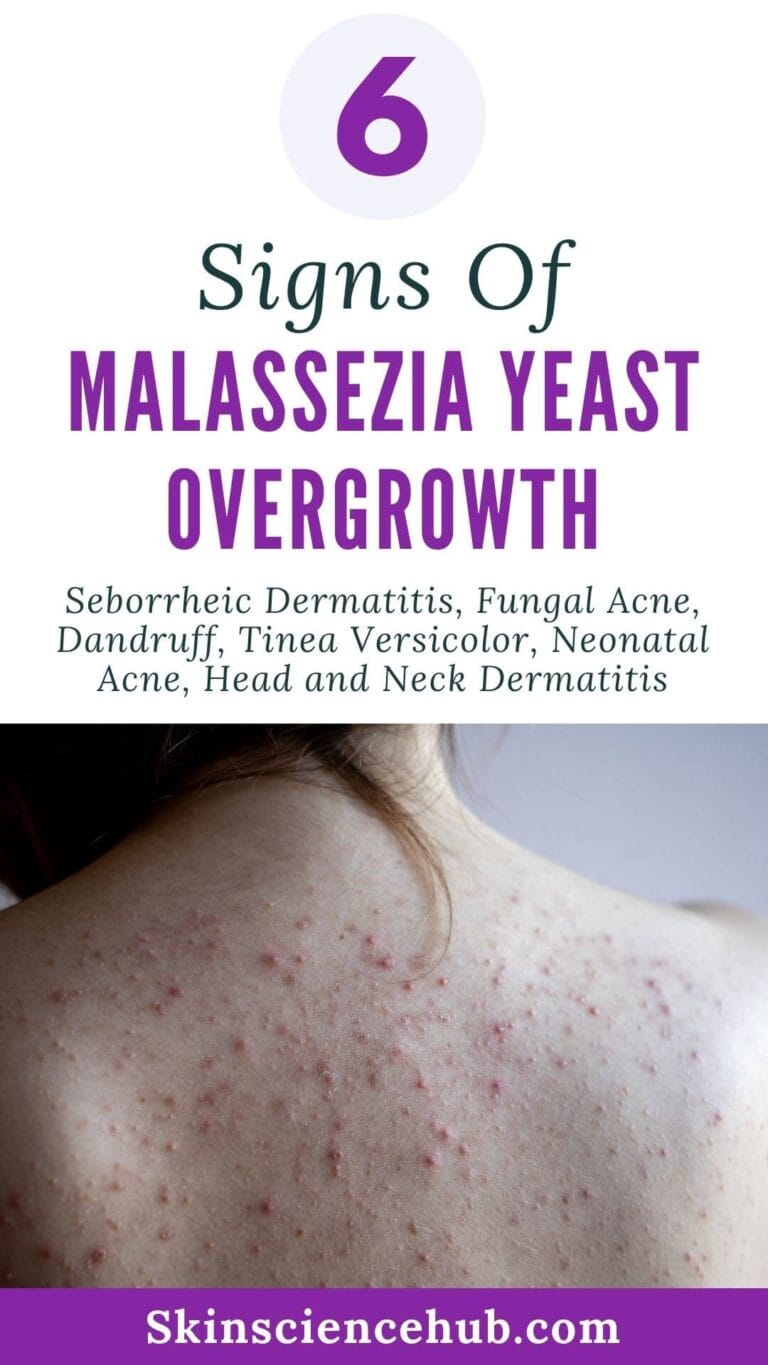 Malassezia Yeast Overgrowth: Causes, Signs and Treatment