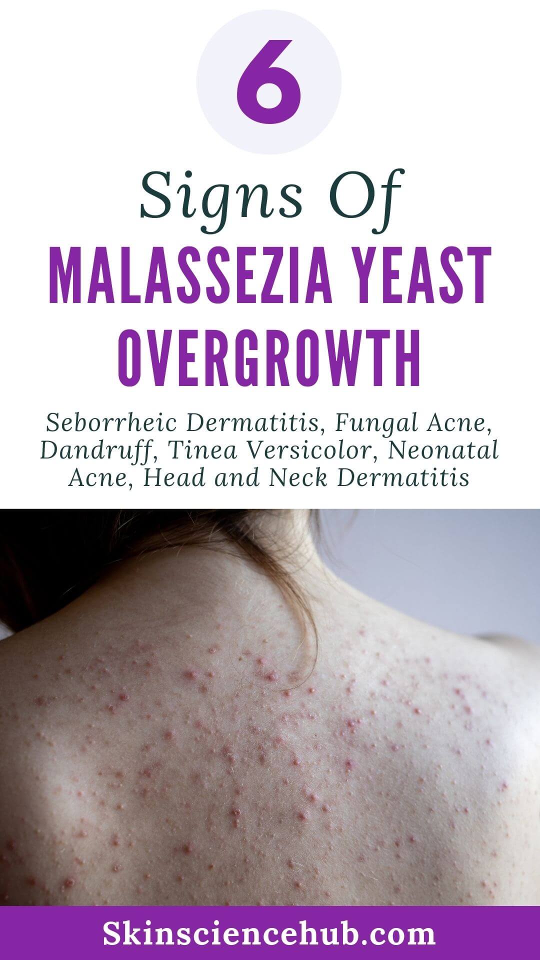 Malassezia Yeast Overgrowth: Causes, Signs and Treatment