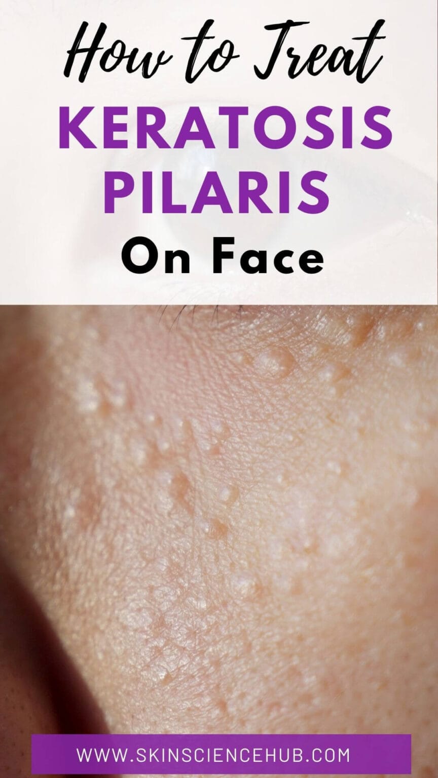 Keratosis Pilaris on Face: Treatments, Causes and What to Avoid